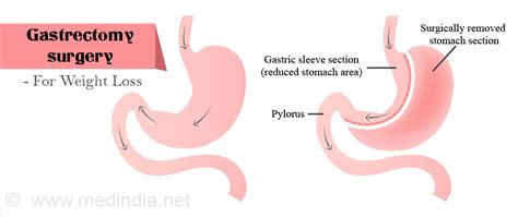 Gastrectomy Diet Modifications Southcorner Barber