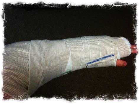 Post Op Wrap After Ulnar Nerve Surgery This Wrap Aint Go Flickr