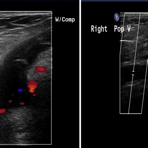 Ascending Venogram Of Right Lower Extremity Prone Position Before And Download Scientific