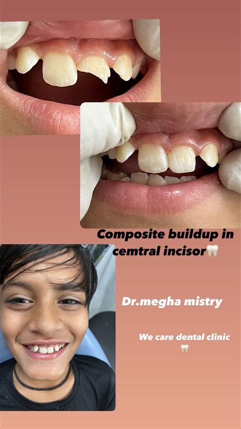 Dr Megha Mistry On Linkedin Ellis Class Iv Fracture In Central Incisor Treatment Apexification…