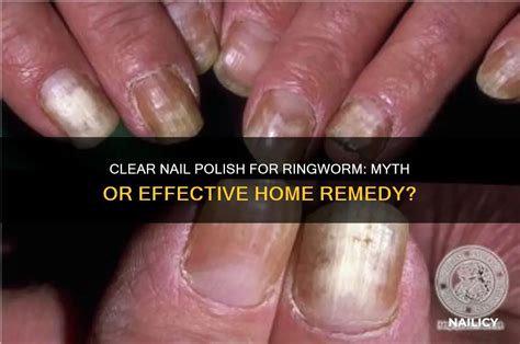 Clear Nail Polish For Ringworm Myth Or Effective Home Remedy Nailicy