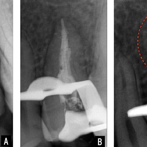 Endodontic Treatment Of 25 With Irreversible Pulpitis Caused By A