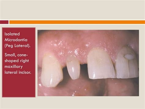 Developmental Disturbances Of Tooth Morphology Ppt
