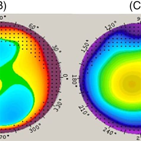Pdf Automatic Detection Of Keratoconus On Pentacam Images Using Feature Selection Based On