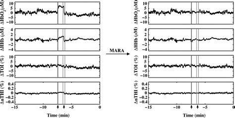 Nirs Data From Patient P5 Before And After The Application Of Mara The