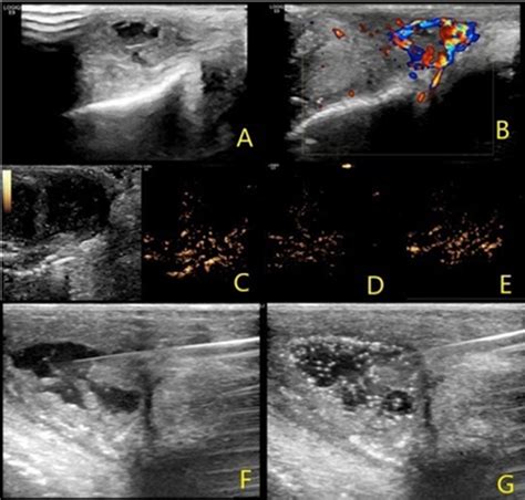 A A Heterogeneous Echogenic Zone At The Root Of The Penis With A