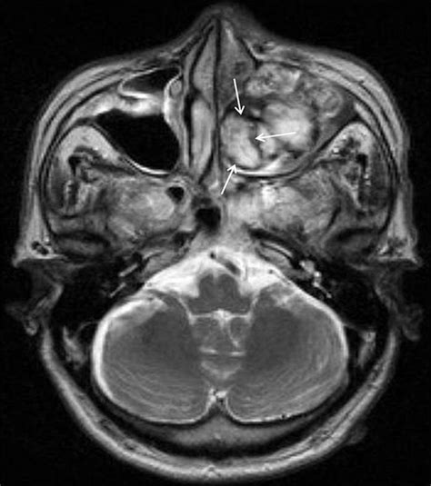 Maxillary Sinus Cancer