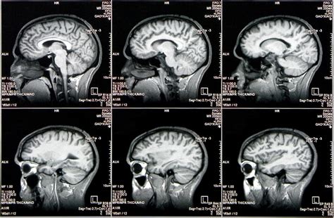 Scans Show Weakened Brain Connections In Adolescents At Risk Of Bipolar