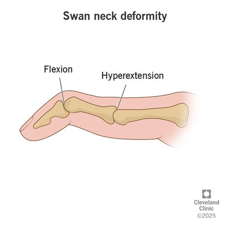 Swan Neck Deformity