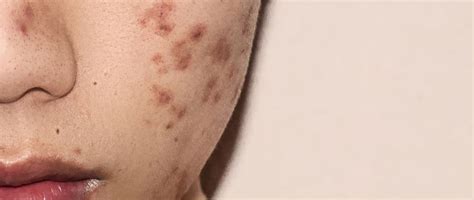 Post Inflammatory Hyperpigmentation And How To Treat It Dr Cp