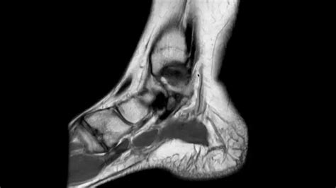 Mri Anatomy Ankle Joint At Riley Heinig Blog