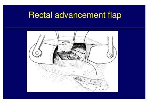 Rectal Advancement Flap