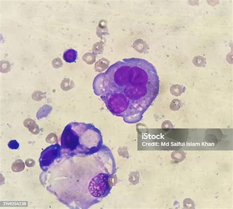 Malignant Fluid Cytology Cells Of Adenocarcinoma May Spread To Fluid Of