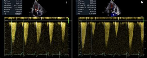 Aortic Cw Doppler Flow Pattern In A Patient With Moderate Aortic Download Scientific Diagram