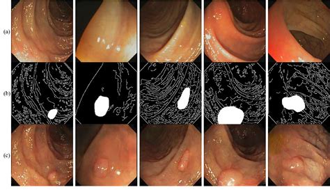 Figure 6 From Abnormal Colon Polyp Image Synthesis Using Conditional Adversarial Networks For
