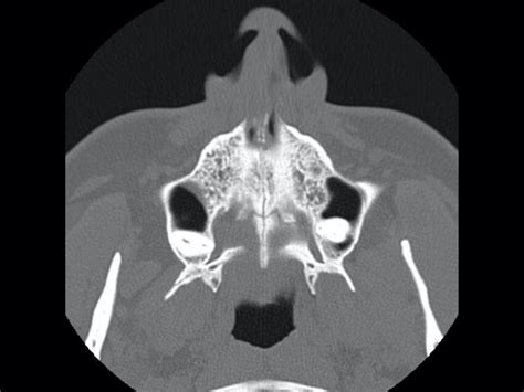 Normal Sinus Ct Annotated Radiopaedia 78917 92019 Axial Nc Commons