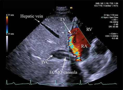 TTE Subcostal Window Long Axis IVC Plane Color Doppler Interrogation Download Scientific
