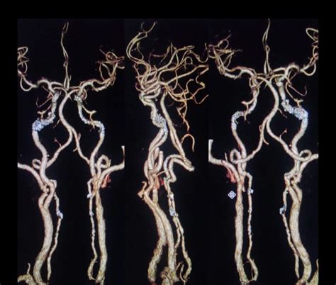 Ahmed Younes On Linkedin Ct Cta Neuro Vascular Gehealthcare