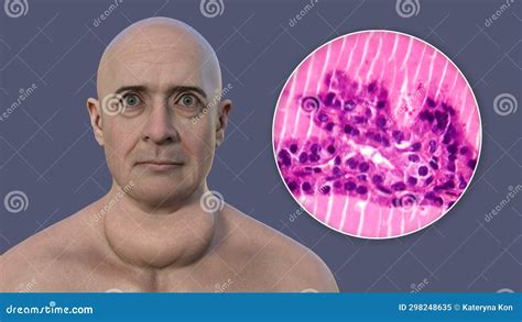 Goiter Enlarged Thyroid Endocrine Disfunction Vector Illustration CartoonDealer Com