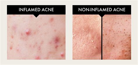 Folliculitis Vs Acne