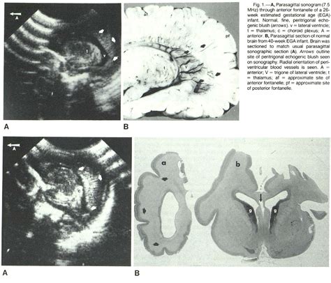 Figure 1 From Peritrigonal Echogenic Blush On Cranial Sonography
