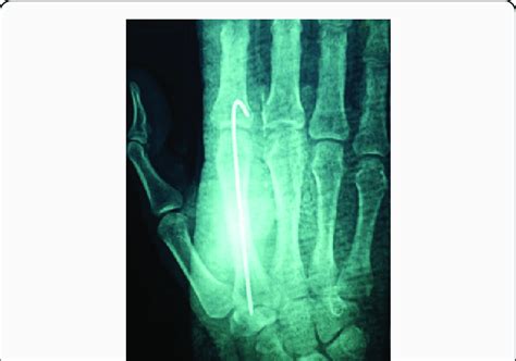 2 Nd Metacarpal Fracture Managed By K Wire Fixation Download