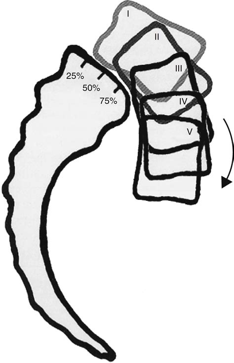 Pictures Of Spondyloptosis Fig 7 Meyerding Classification