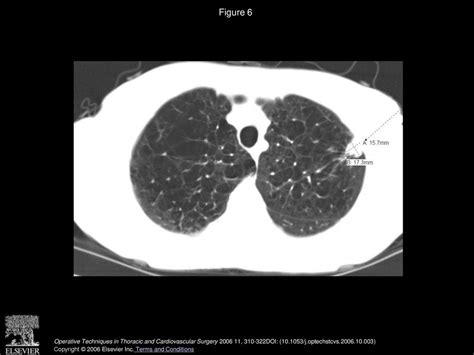 Lung Segmentectomy For Patients With Peripheral T1 Lesions Ppt Download