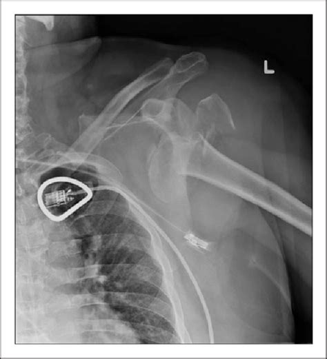 Complex Anterior Fracture Dislocation Of The Proximal Humerus Download Scientific Diagram