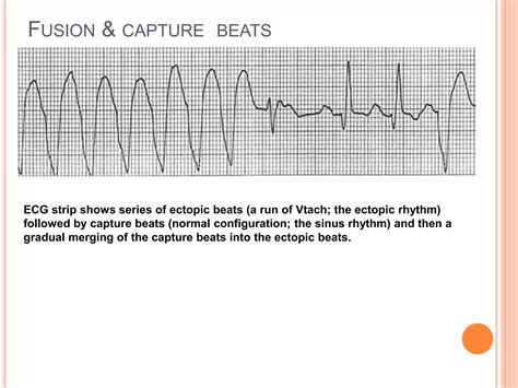 Vt In Structurally Normal Heart Pptx