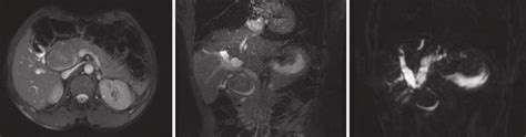 Extrahepatic Distal Common Bile Duct Cholangiocarcinoma Download