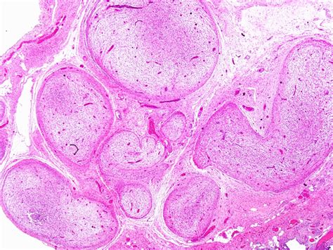Plexiform Neurofibroma Histology