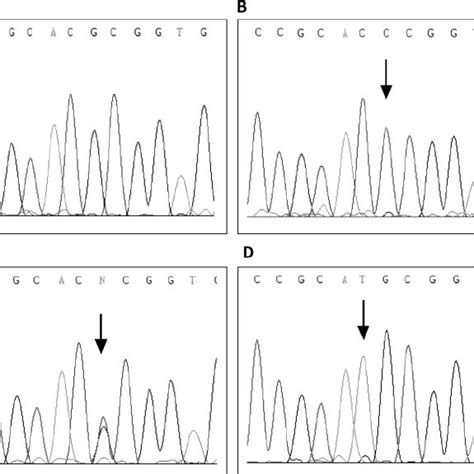 Chromatogram Showing The Sequencing Analysis Of Exon 3 Of Pax9 From