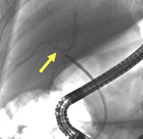 Digital Cholangioscope Assisted Retrieval Of A Proximally Migrated Plastic Biliary Stent Pmc