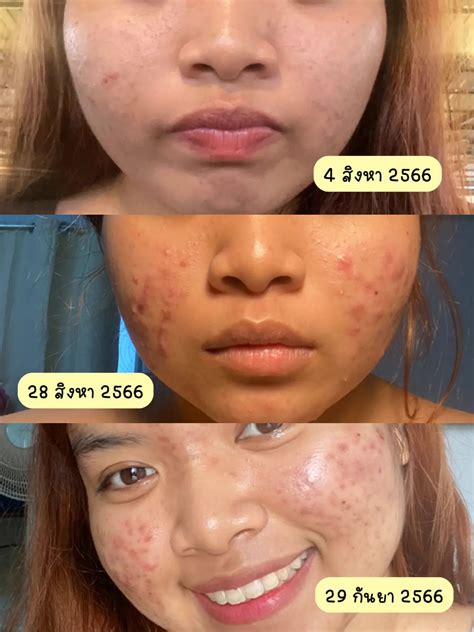 รักษาสิวด้วยตัวเองแบบ 300ในเวลา 3 เดือน แกลเลอรีที่โพสต์โดย พอยพอย 🍅