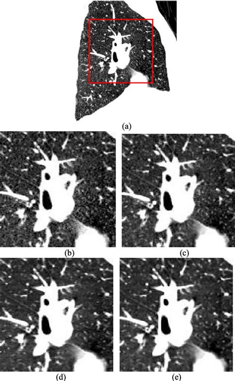 figure 5 from improving low dose ct image using residual convolutional