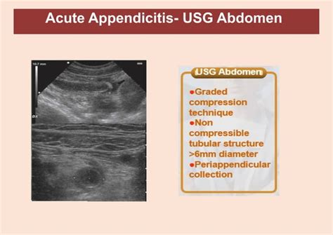 Acute Appendicitis Appendicectomy Open And Laparoscopicpdf Surgery
