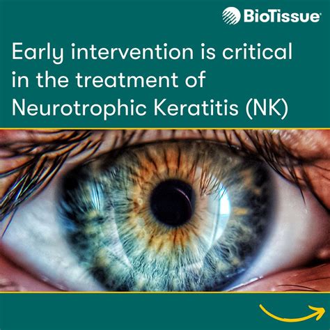Biotissue Ocular On Linkedin Nk Spk Prokera Neurotrophickeratitis