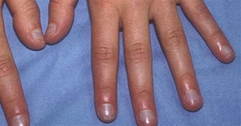 Các Biểu Hiện Cơ Thể Bên Ngoài Móng Tay Của Người Bị Bệnh Tim đáng Chú ý