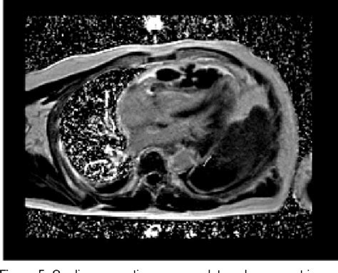 Figure 1 From Images In Cardiovascular Medicine Bacterial Pericarditis