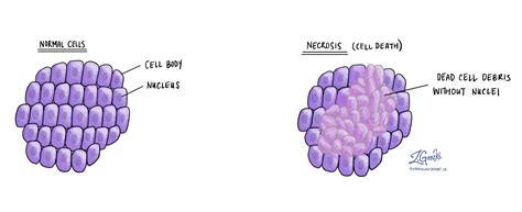 Necrosis Mypathologyreport