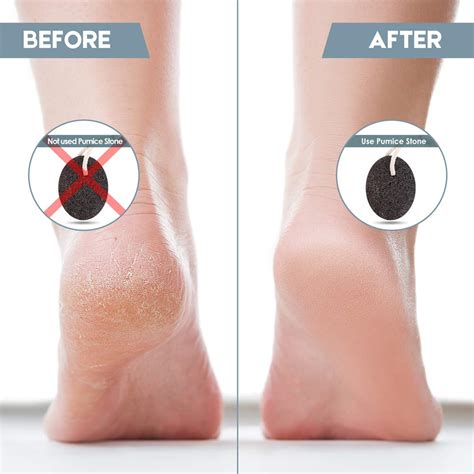 Foot After Pumice Stone At Eugene Goff Blog