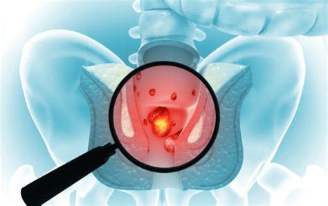 Hemorrhoid Grading System Stages And Degree Classification