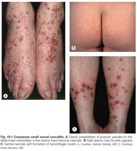 Pictures Of Vasculitis On Skin