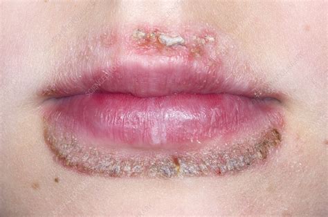 Dermatitis Around The Mouth Stock Image C016 8176 Science Photo Library