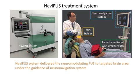 Ultrasound Treatment Can Target Neural Circuits Of Epilepsy Quicknews