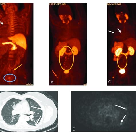 18f Dcfpyl Mip Image Shows Normal Physiologic Uptake Within The