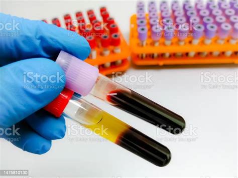 기술자는 의료 검사를 위해 혈청 샘플 튜브와 라벤더 튜브를 혈액 샘플로 보유합니다 Stem 주제에 대한 스톡 사진 및 기타 이미지 Stem 주제 건강 검진 건강 진단