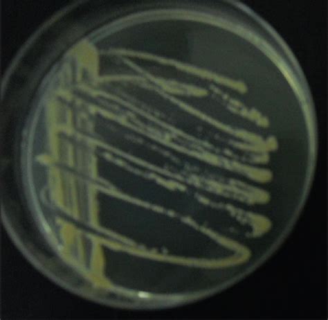 Disseminated Cryptococcosis Indian Journal Of Dermatology