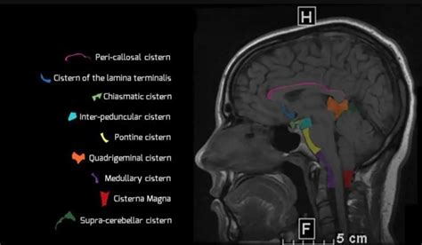 Radioanatomy 𝗖𝗲𝗿𝗲𝗯𝗿𝗮𝗹 𝗖𝗶𝘀𝘁𝗲𝗿𝗻𝘀 𝗥𝗮𝗱𝗶𝗼𝗮𝗻𝗮𝘁𝗼𝗺𝘆 𝗠𝗼𝗯𝗶𝗹𝗲 𝗔𝗣𝗣